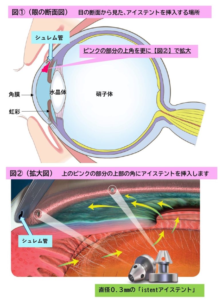 iStent(アイステント)による低侵襲緑内障手術 - 新江古田いわた眼科